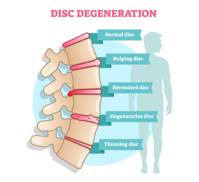 What Are Different Types of Disc Problems | QI Spine
